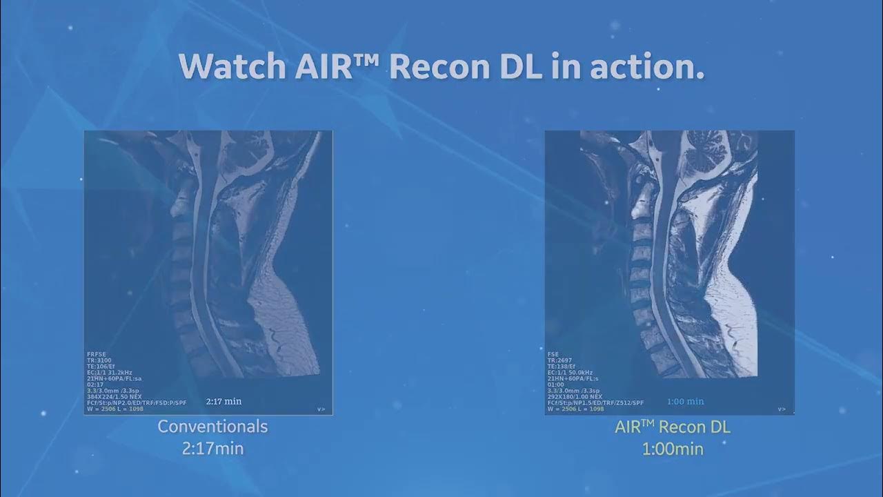 Leverage the Power of A.I. in MRI Scans with AIR™ Recon DL - YouTube