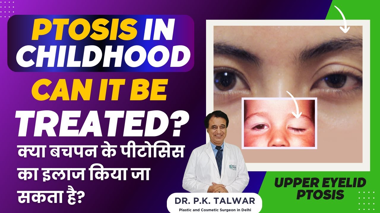 Childhood ptosis-related eye swelling: Treatable? Ptosis Surgery ...