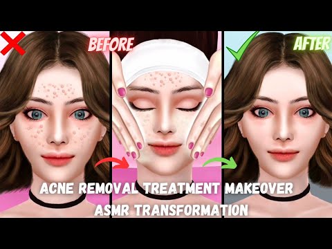 ASMR ACNE removal Pimple Extraction | SPA Treatment ASMR TRANSFORMATION ...