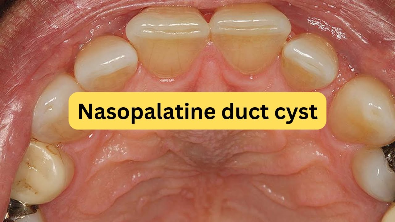 What is nasopalatine duct cyst? EASY!! - YouTube