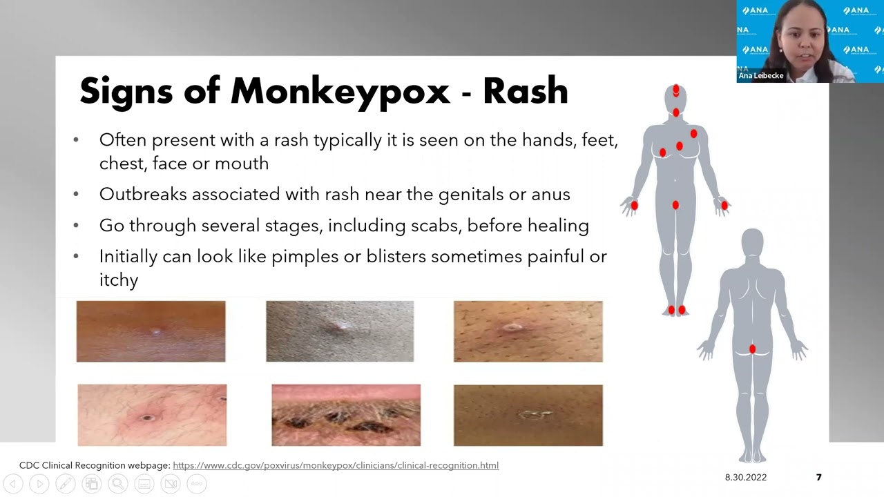 Practical Tips for Healthcare Workers During the Current Monkeypox ...