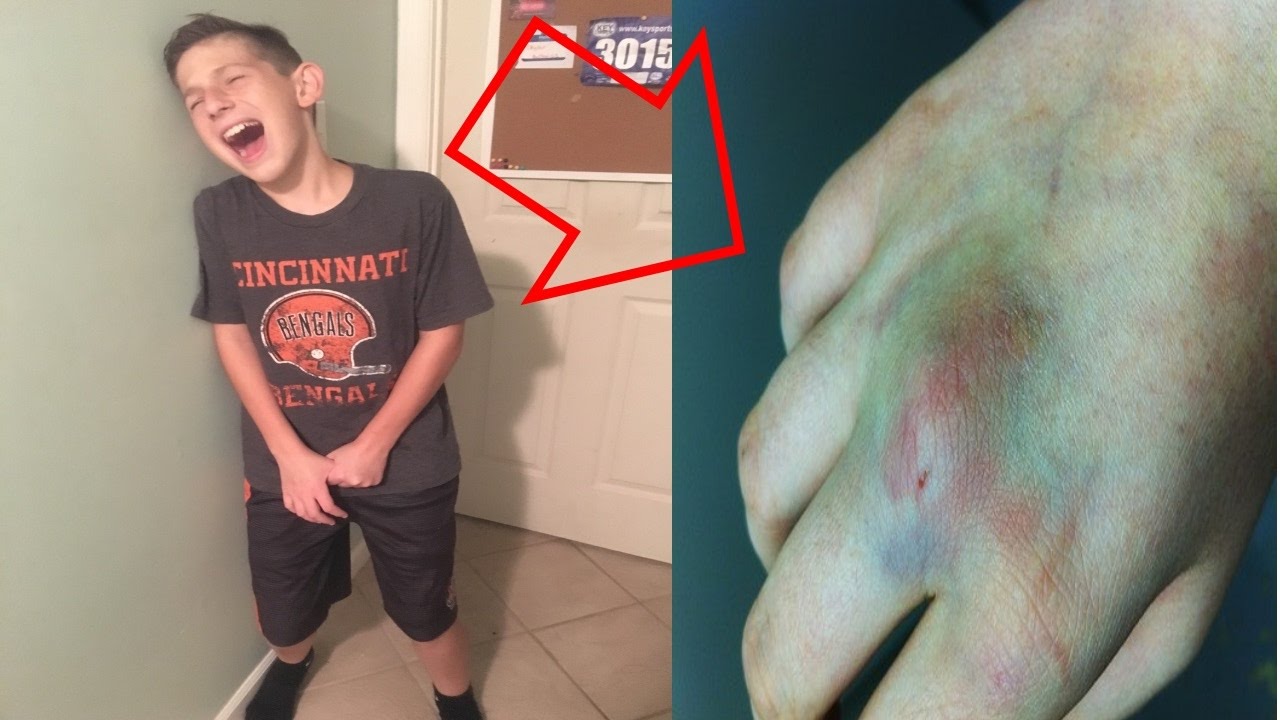 I PINCHED MY HAND!! (HURTS BAD) (Day 68 - 9/30/16) - YouTube