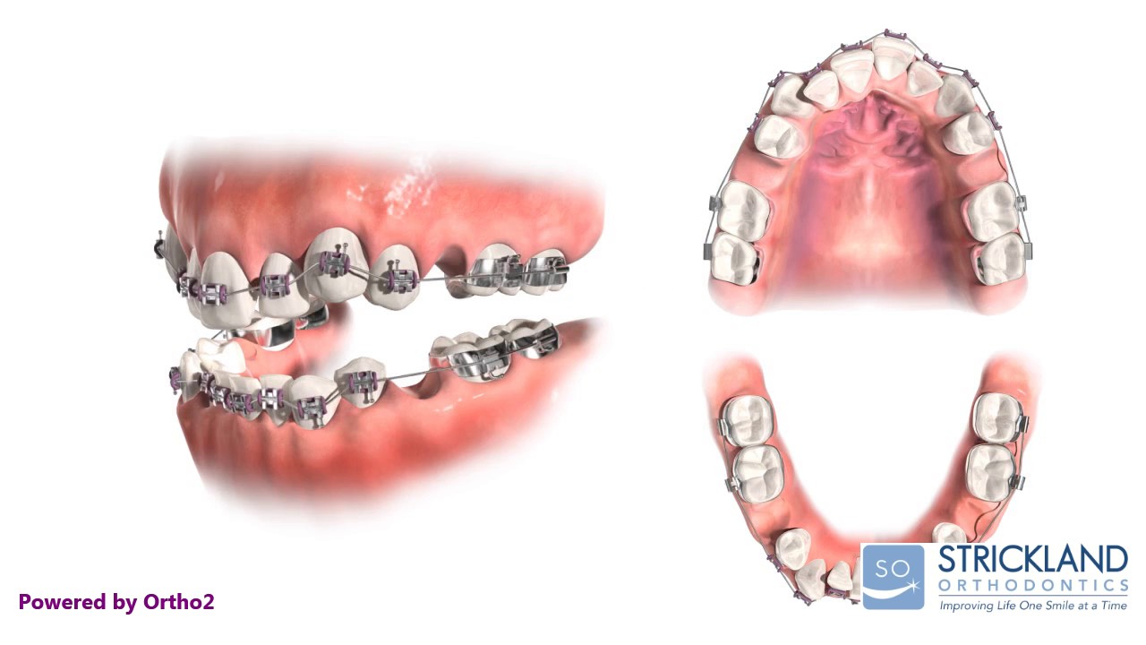 Second Bicuspid Extraction SO - YouTube