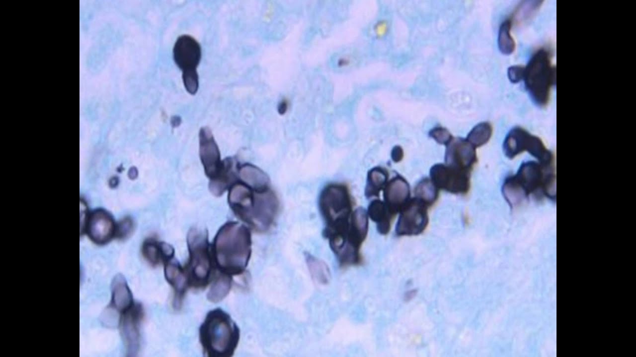 Blastomycosis Blastomyces Dermatitidis Youtube