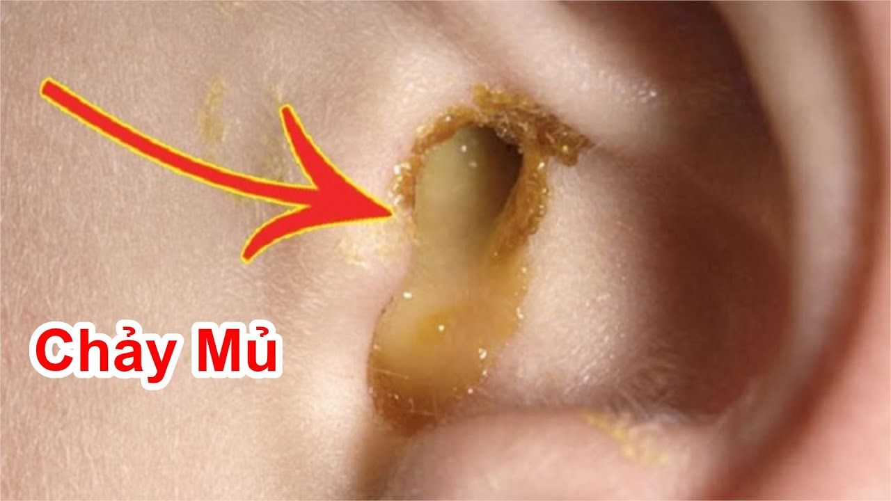 Cách Trị Viêm Tai Giữa Hiệu Quả , Trị Lỗ Tai Bị Chảy Mủ , Viêm Lỗ Tai ...