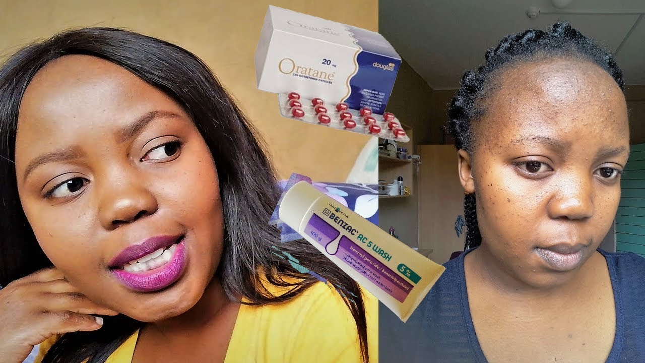 How to get rid of pimples and products you need| south african youtuber ...