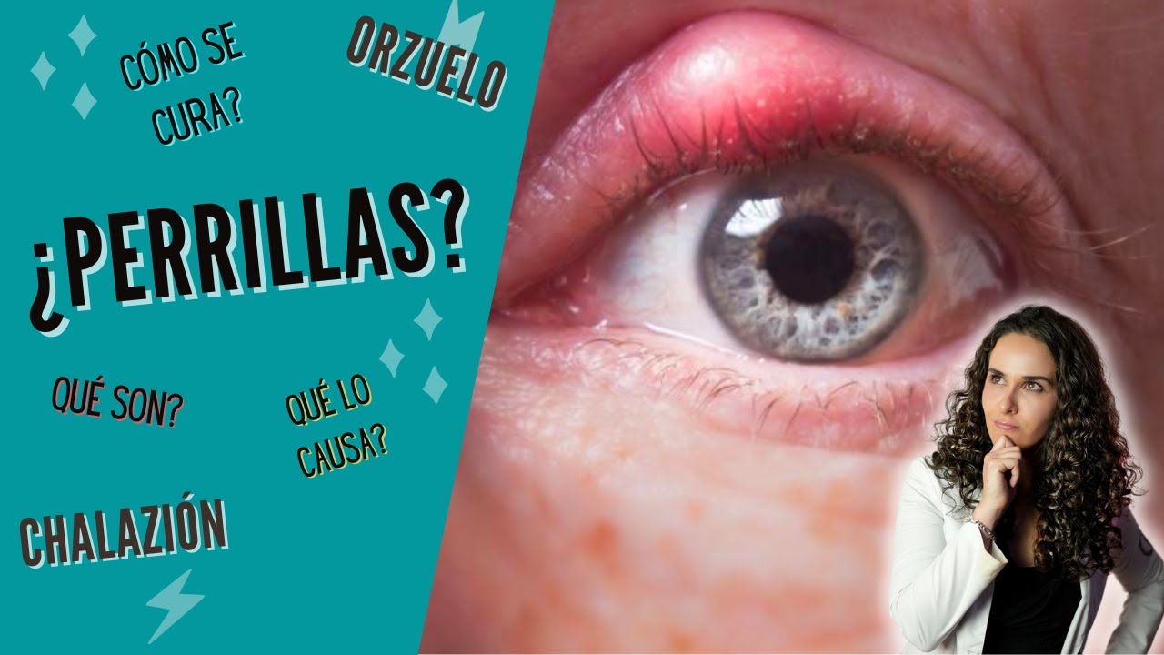 ¿Por qué sale una perilla?, Te digo porque salen y como tratarlas al ...
