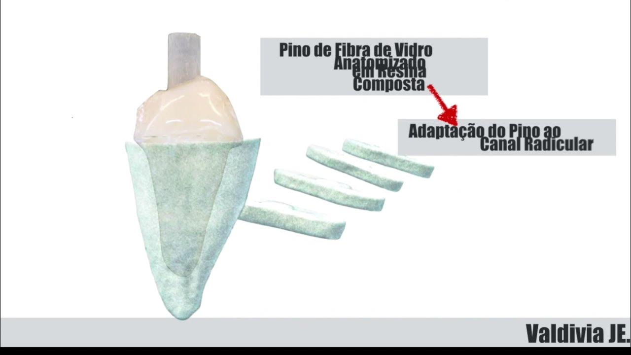 Pinos de fibra de vidro anatomizados em resina composta (Adaptação ...