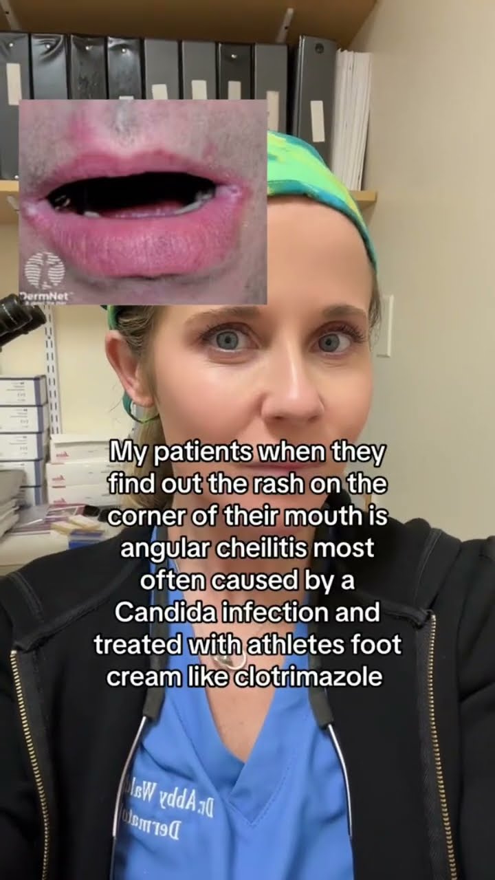 Angular cheilitis often occurs with dentures, or sagging of the mouth ...