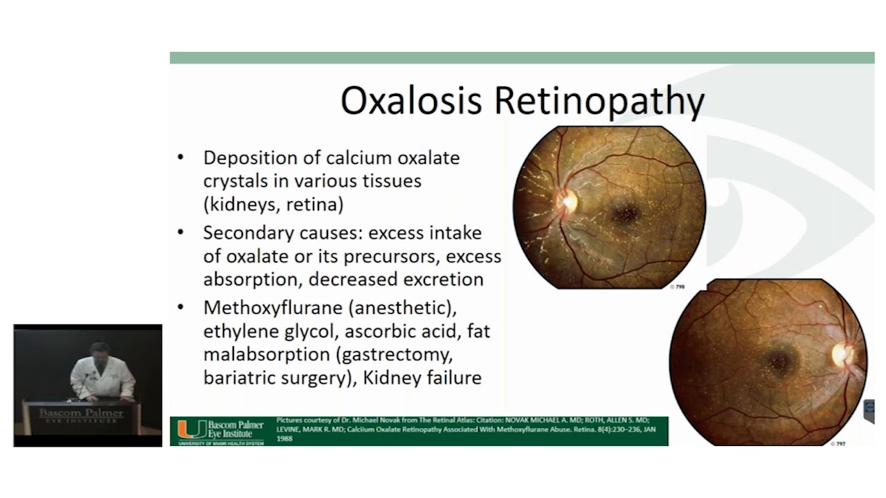 Bascom Palmer Grand Rounds - Dot and Fleck Retinopathy Secondary to ...