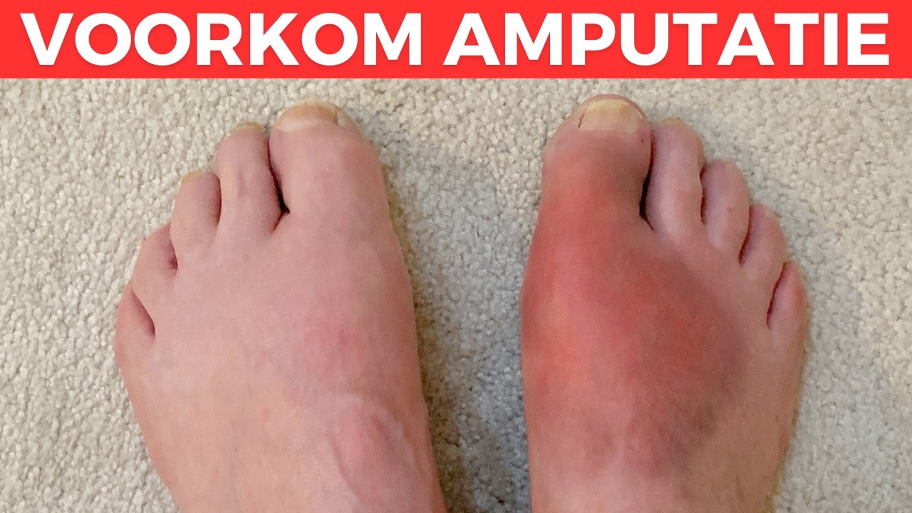 Doof Gevoel In Je Tenen? Oorzaak, 7 Symptomen van Suikerziekte ...