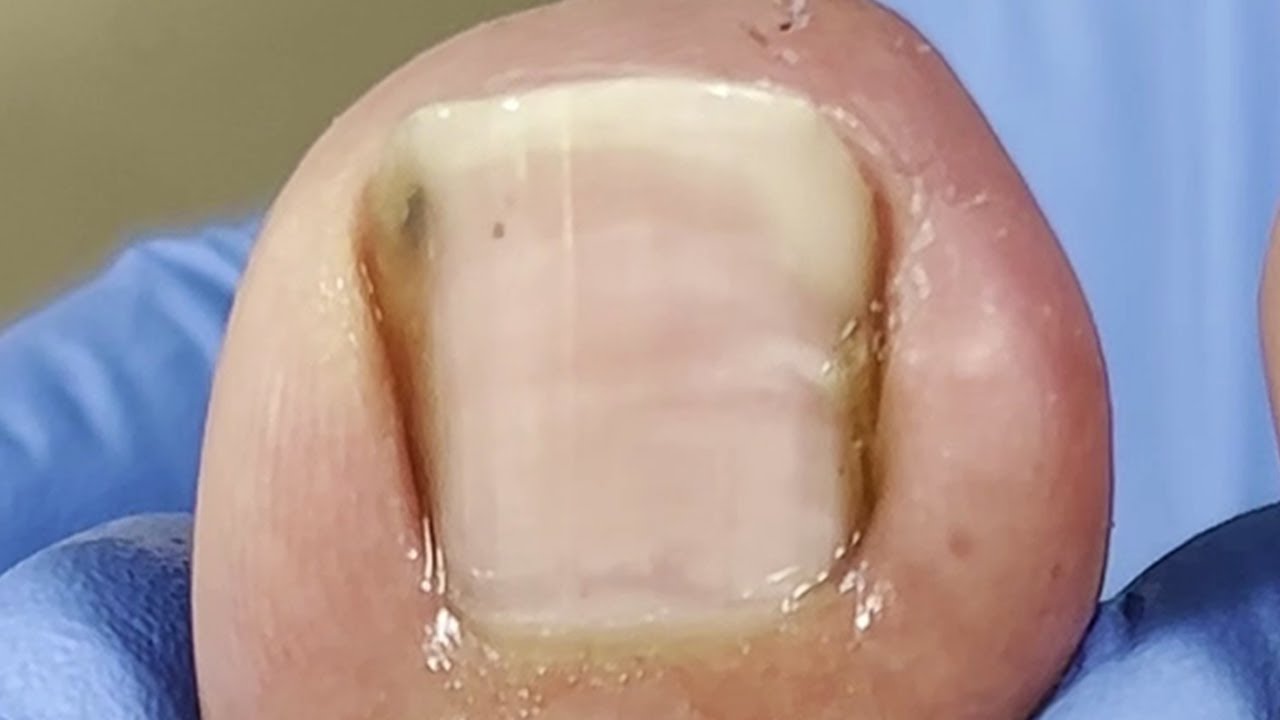 Perfectly trim long toenails and give it a good shape【Xue Yidao】 - YouTube