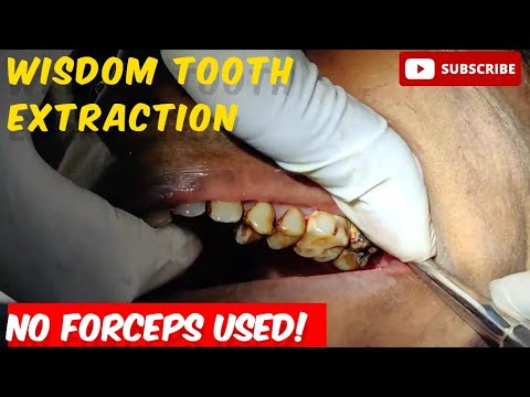 Wisdom Tooth Extraction- Using Cryers Elevator #toothextractions # ...