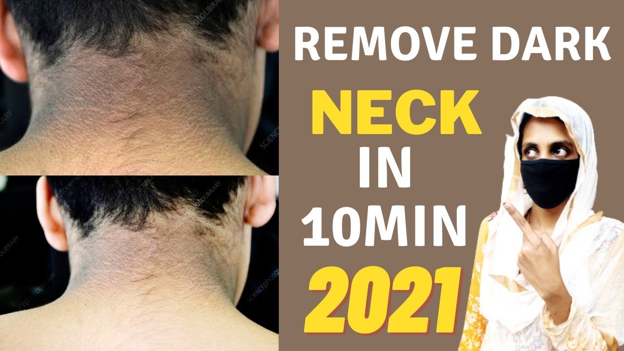 How To Remove Dark Neck At Home | Dark Neck Removal | Black Neck ...