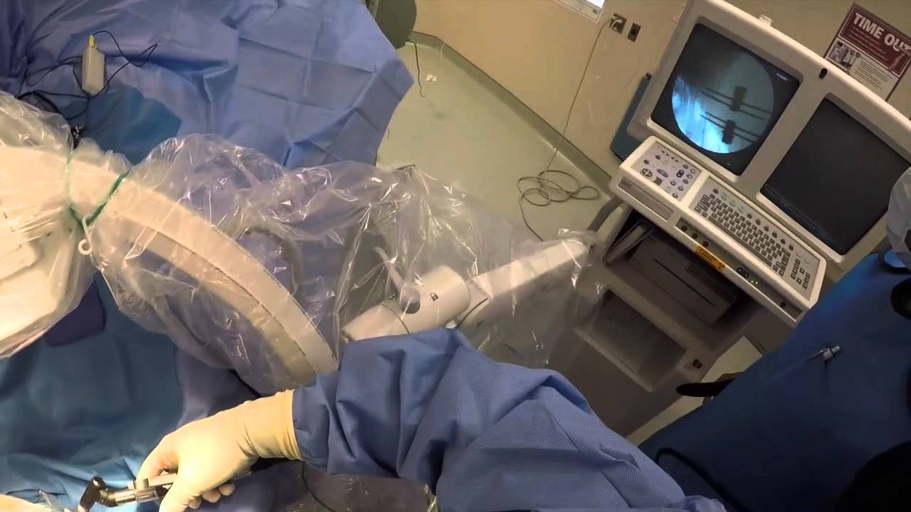 Mini Rail external fixator - YouTube