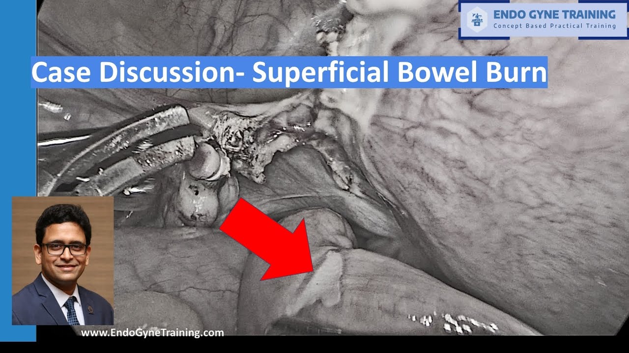 Bowel Burn Injury in laparoscopy | With Voiceover - YouTube