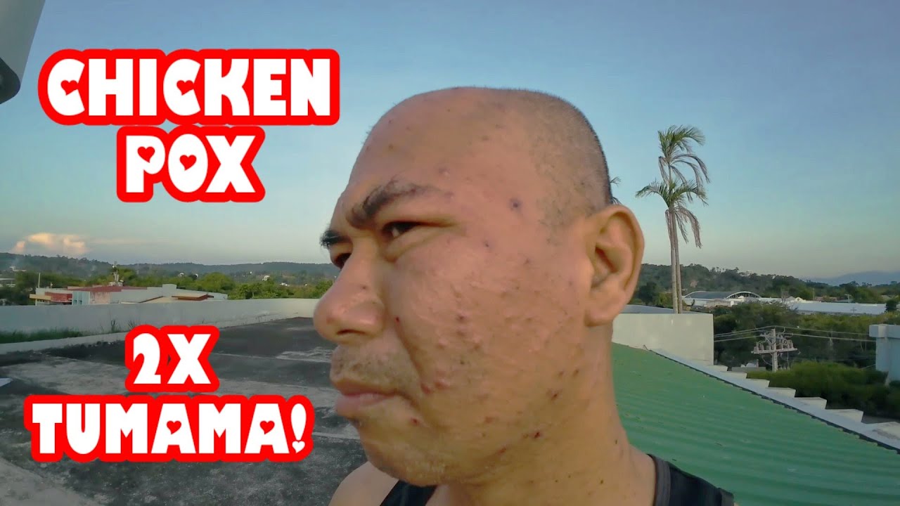 Paano Nakakahawa ang Bulutong Tubig? Tatlong Beses Maaaring Maranasan ...