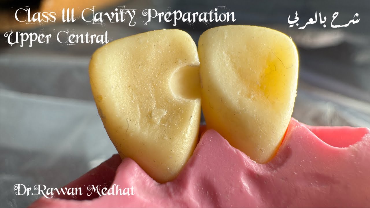 Class lll Cavity Preparation | in Upper Central Incisor | Dr Rawan ...