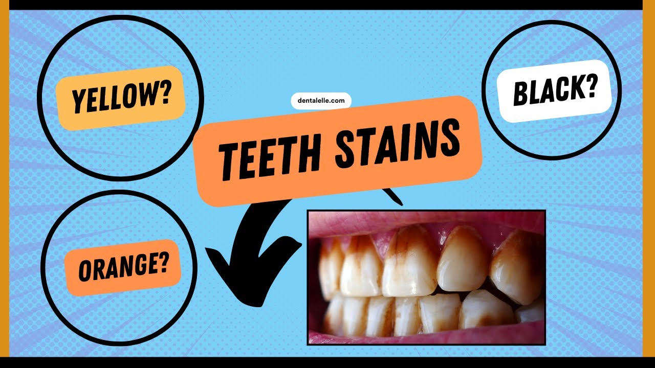 Why Teeth Stain and How To Prevent Staining - YouTube