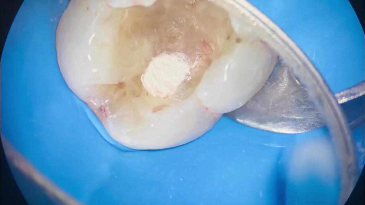 Direkt Pulp Capping with PUTTY MTA - YouTube