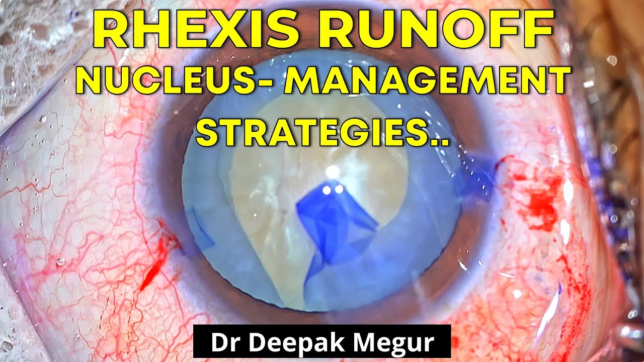 Rhexis Runoff again..! My Top Strategies to deal with this. Dr Deepak ...