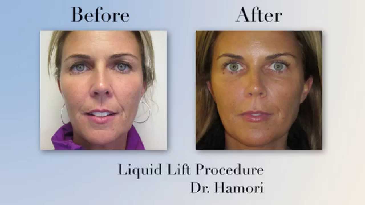 Liquid Face Lift Before And After