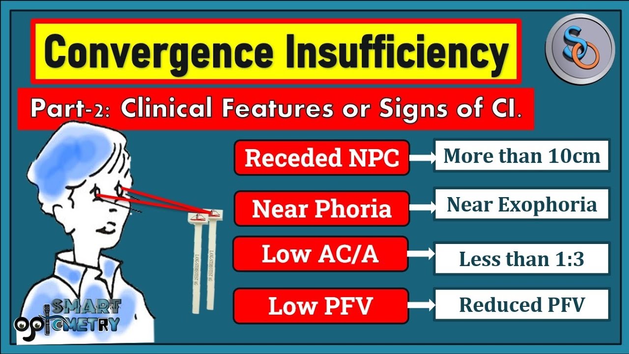 Part-2: Clinical Features or Signs of Convergence Insufficiency (NPC ...