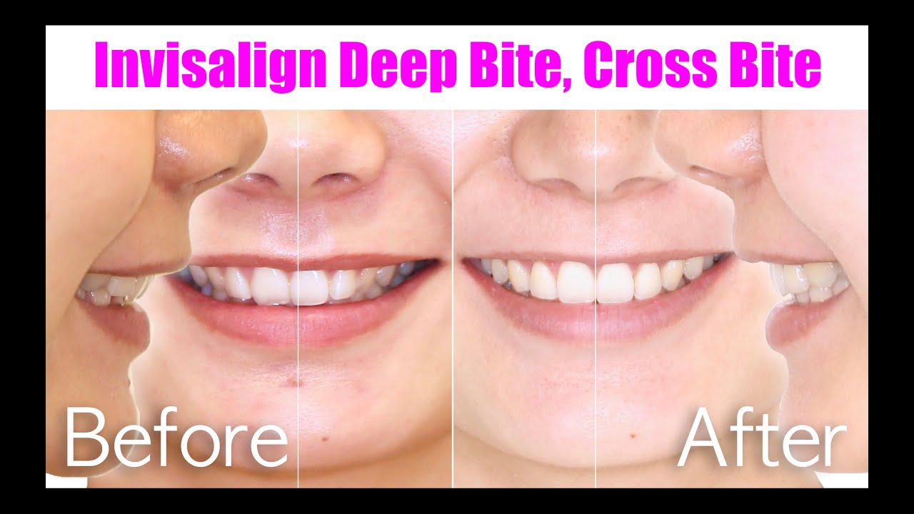 Invisalign【Cross Bite, Deep bite】Non Extraction Approach - YouTube