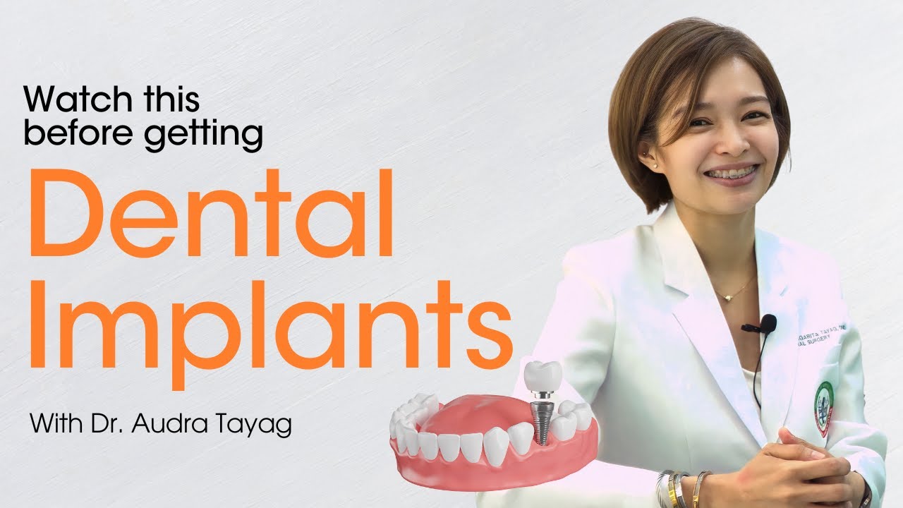 Urban Smiles Dental Clinic Teeth Talk Episode 5: Dental Implants - YouTube