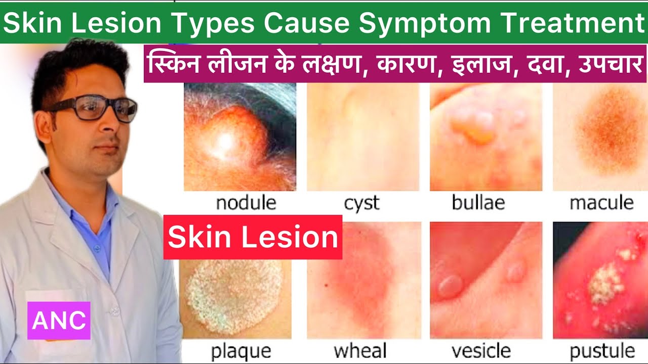Skin Lesions Cause Symptom Diagnosis Treatment In Hindi Skin Lesion