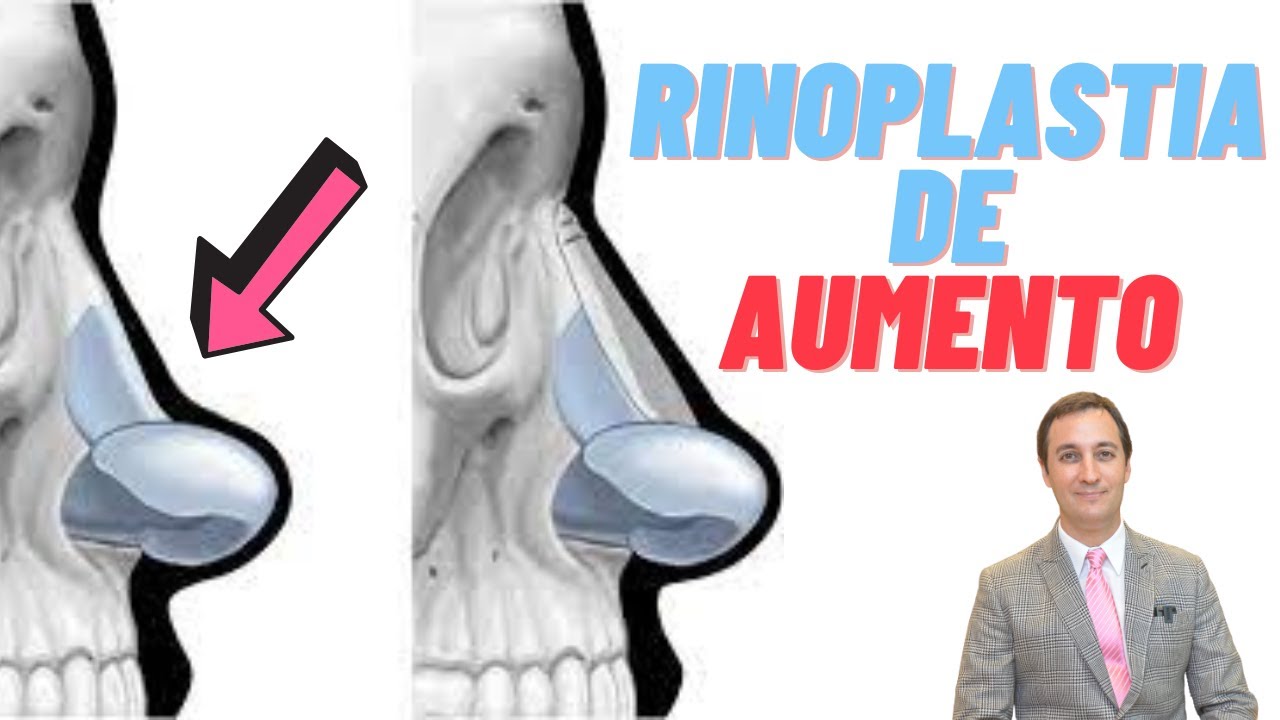 Rinoplastia para aumentar o nariz - YouTube