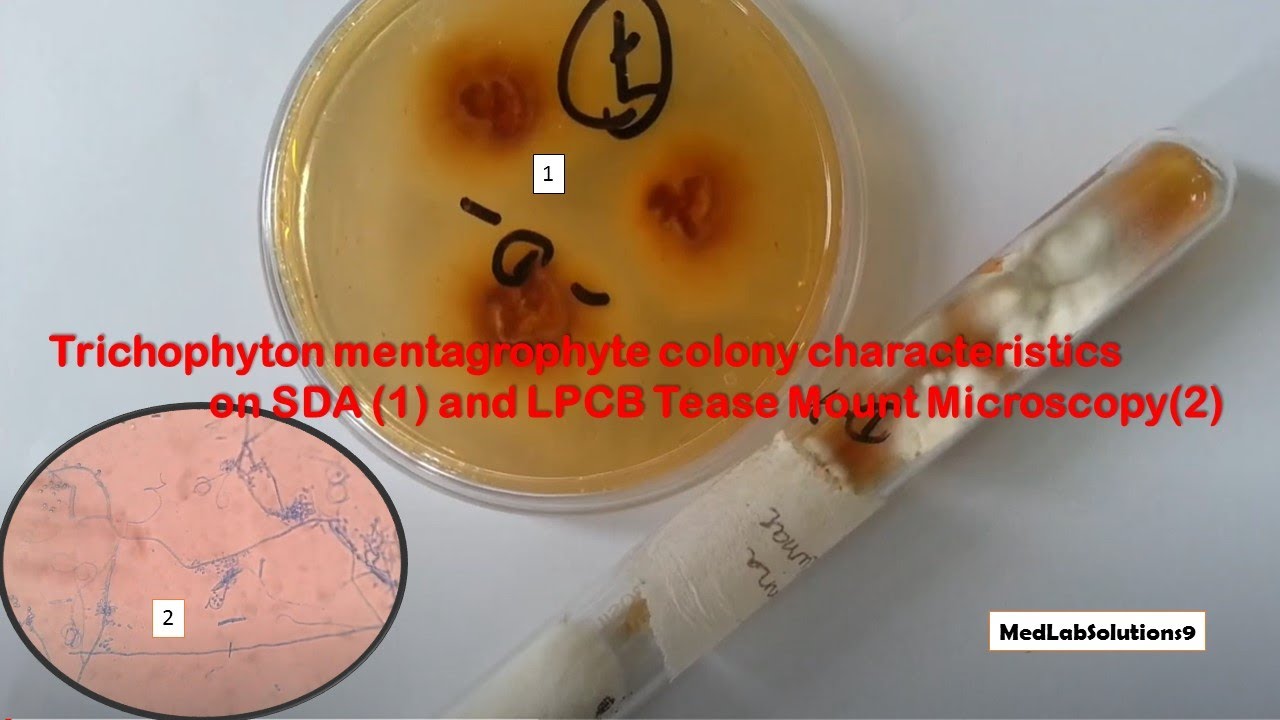 Trichophyton mentagrophyte colony characteristics on SDA and LPCB ...
