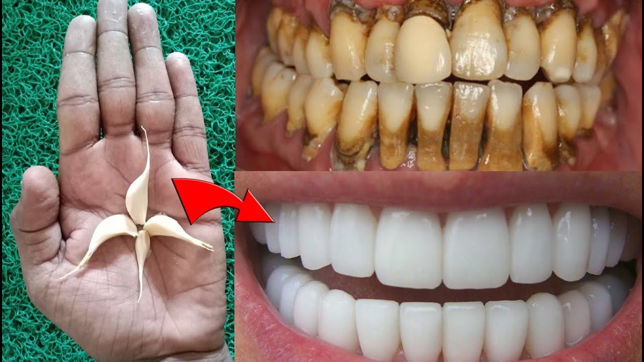5 minutes teeth whitening remedy with garlic || 5 मिनट दांतों को सफ़ेद ...
