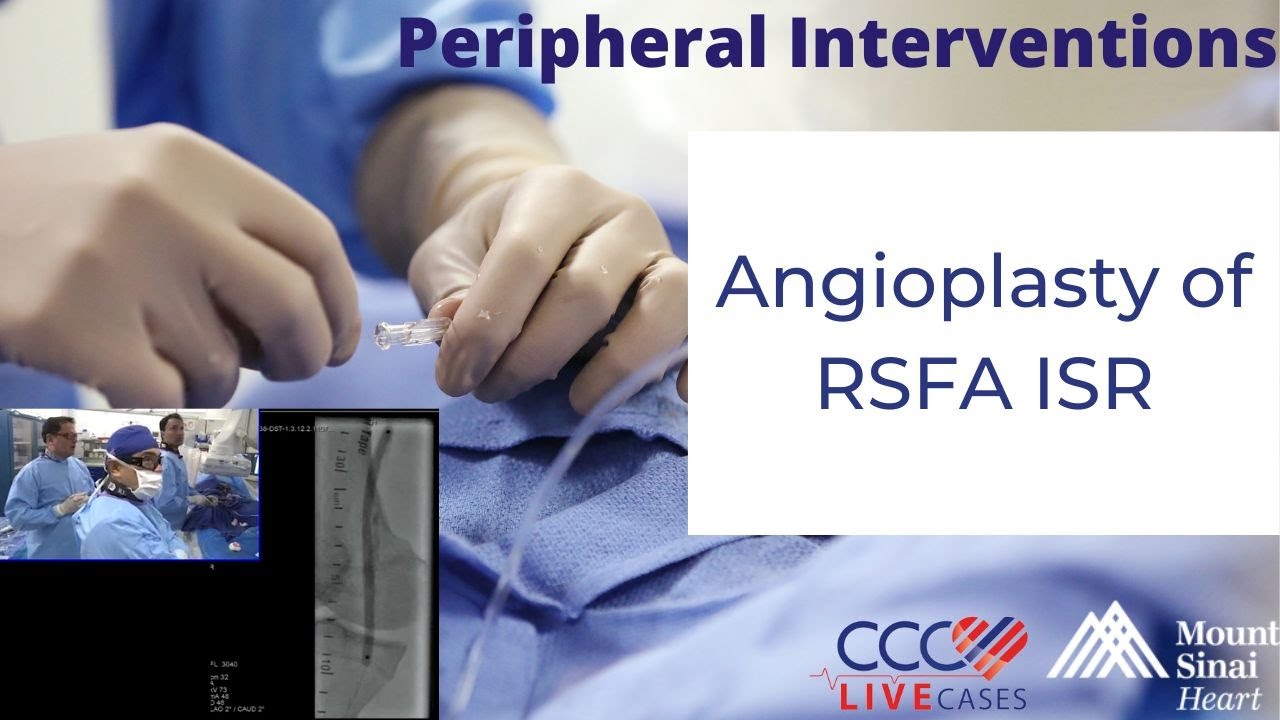 Angioplasty of RSFA ISR - April 27, 2016 Live Case - YouTube