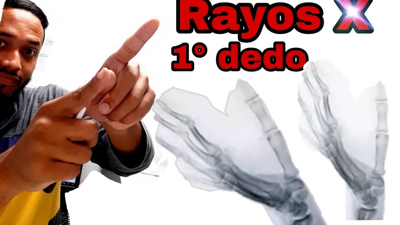RAYOS X 1° DEDO DE LA MANO / Tips - YouTube