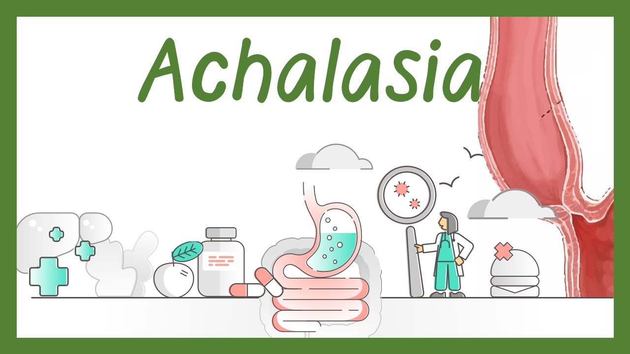 Achalasia (esophageal) in children: Pathogenesis, symptoms and ...