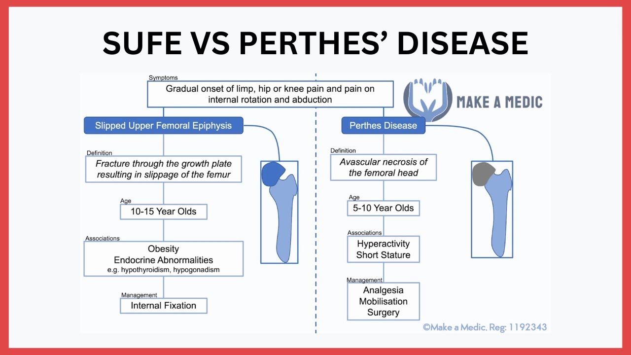 Slipped Upper Femoral Epiphysis (SUFE) vs Perthes Disease - YouTube