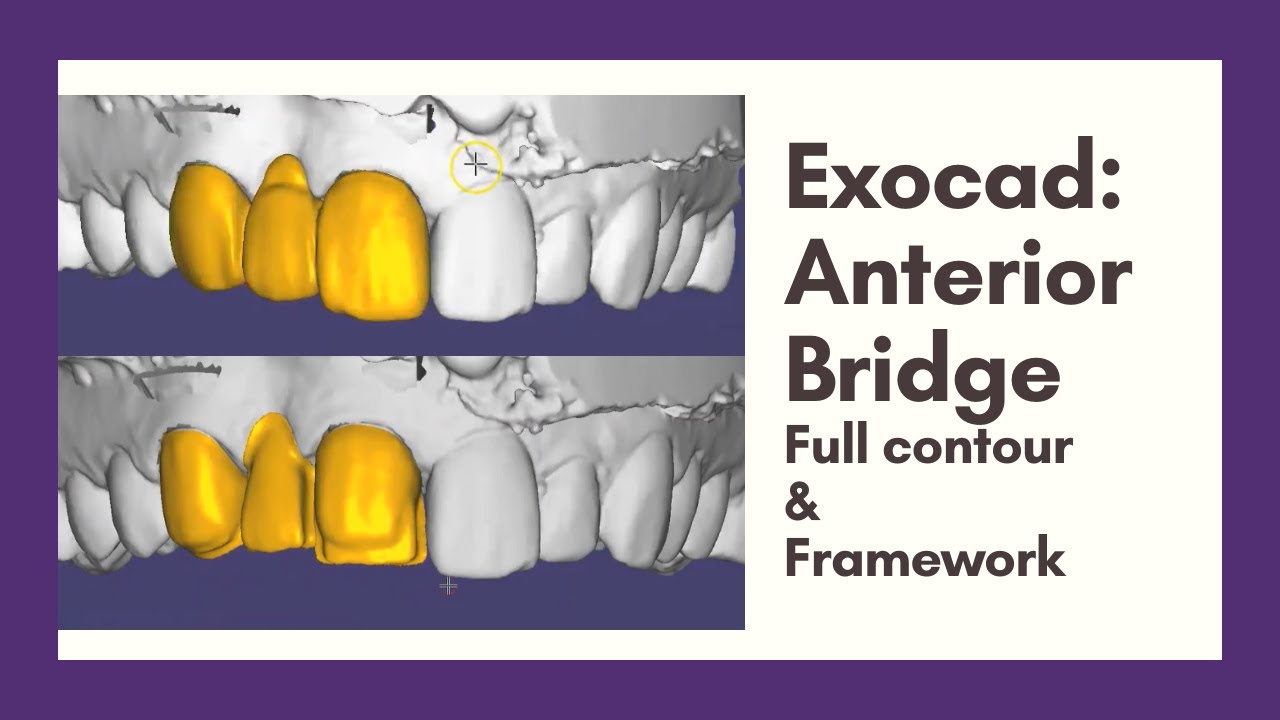 Exocad: Anterior Bridge (Full contour & Framework/Coping) - YouTube