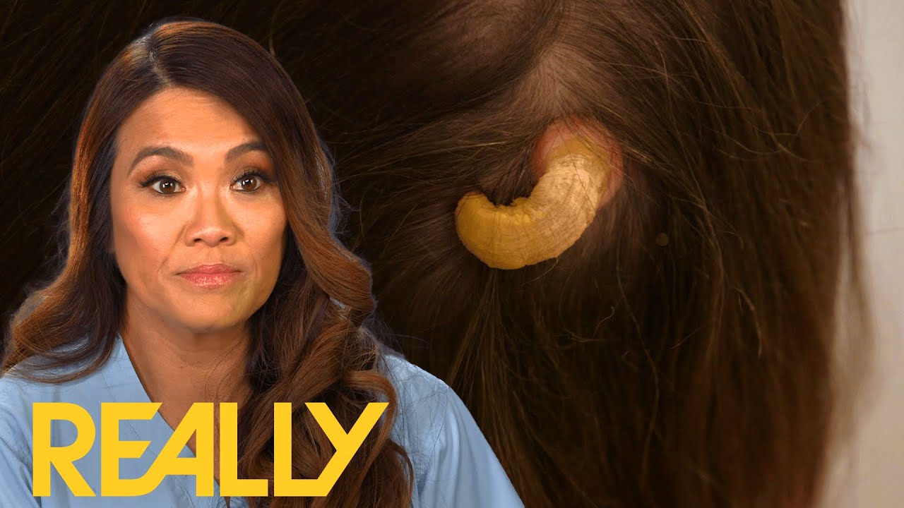 Dr. Pimple Popper Removes A Potentially Cancerous Horn From This ...