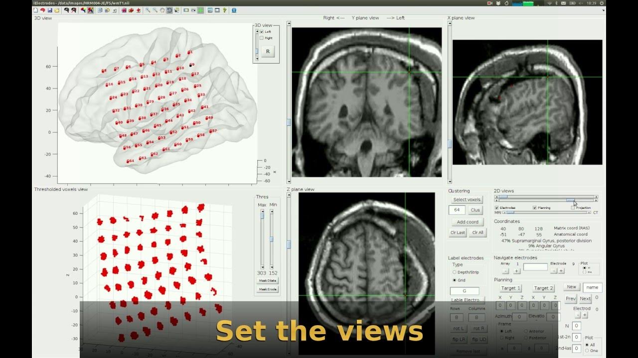 iElectrodes - Localising intracranial grid electrodes tutorial - YouTube