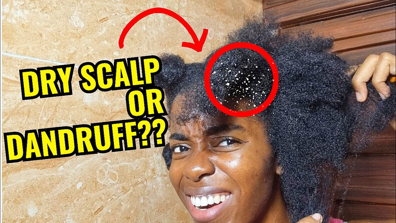 DANDRUFF vs DRY SCALP! What is the DIFFERENCE #dryscalpremedy #dryscalp ...