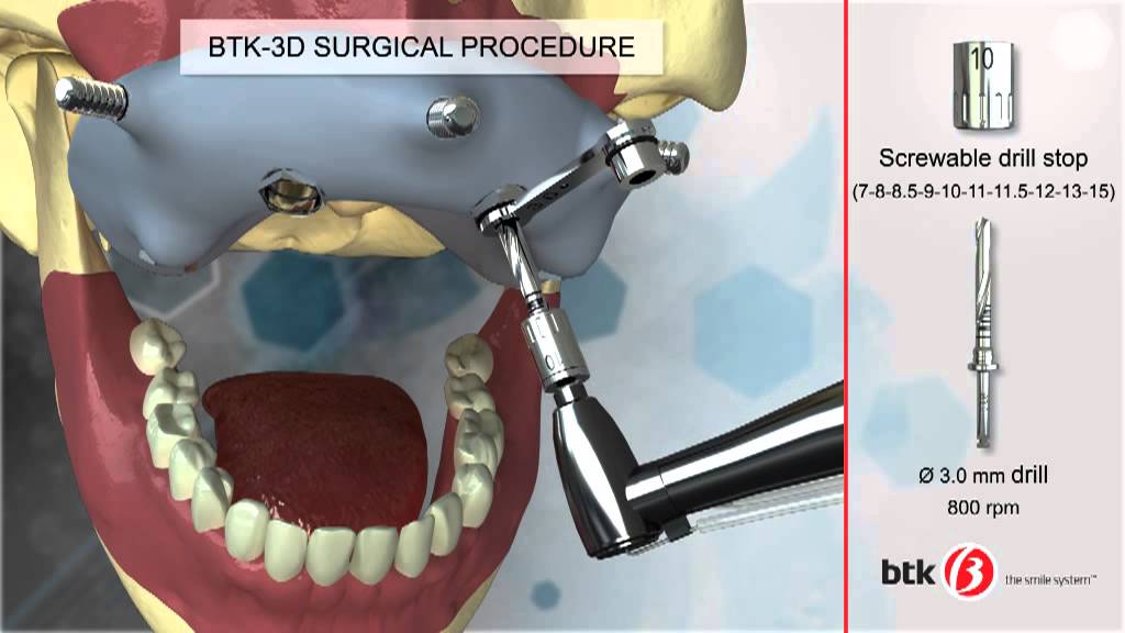 BTK The Smile System - Protocol Computer-Guided Surgery BTK-3D - YouTube