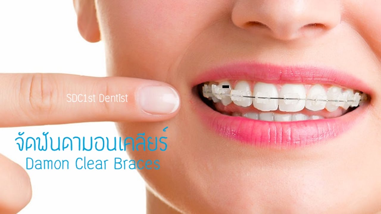 จัดฟันดามอนเคลียร์ รู้เรื่อง! (Damon Clear Braces) - YouTube