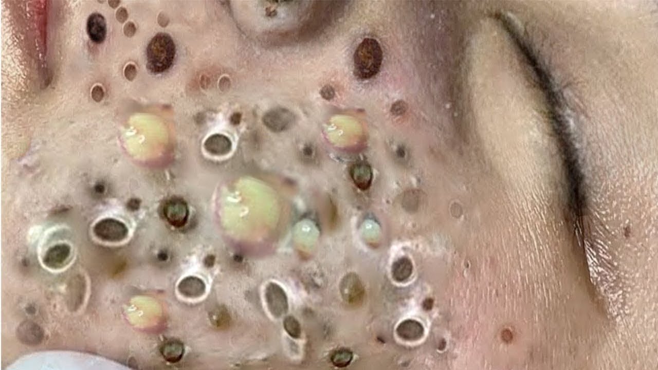 EXTREME Blackhead Cyst Acne Popping #3 - YouTube