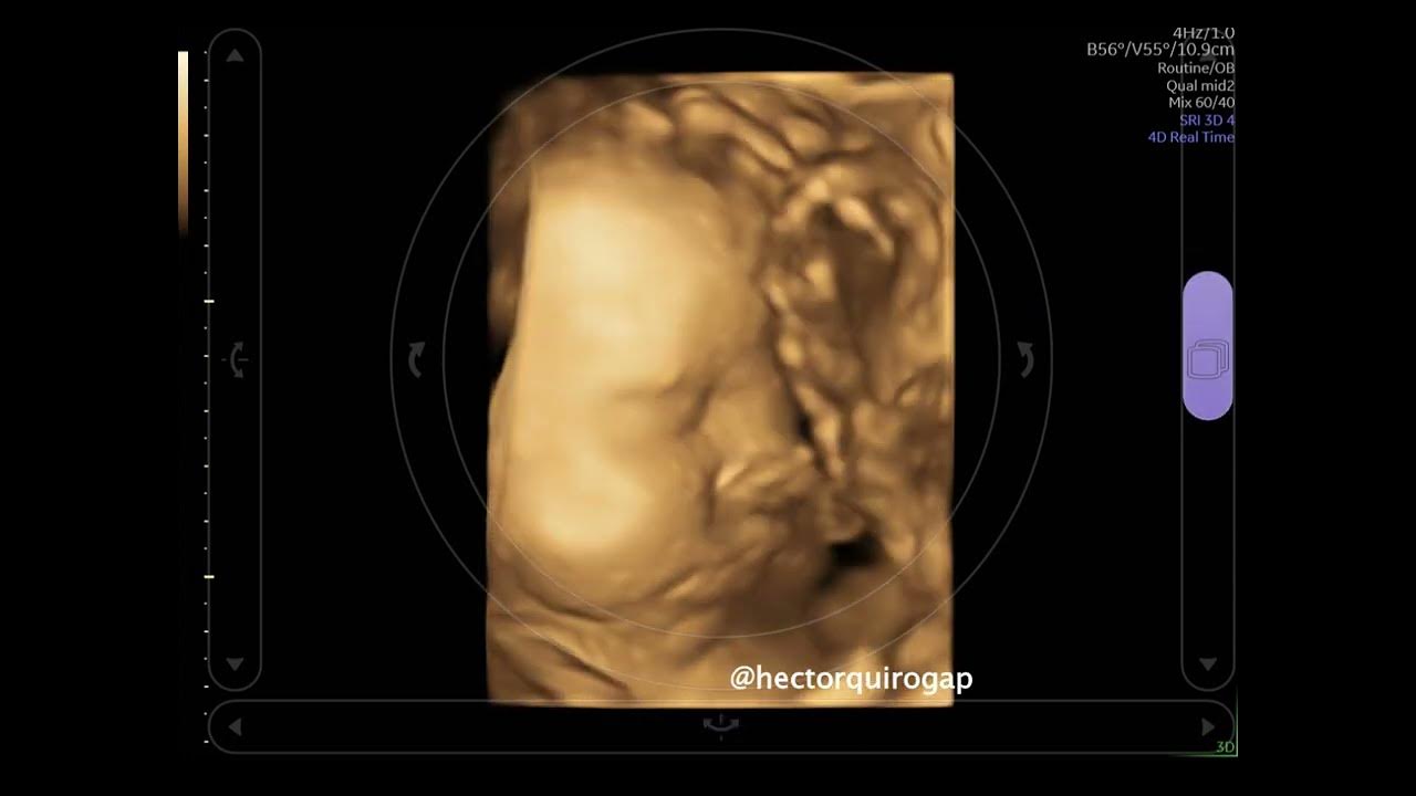 5D ultrasound: 33 weeks fetal face. Voluson Swift - YouTube