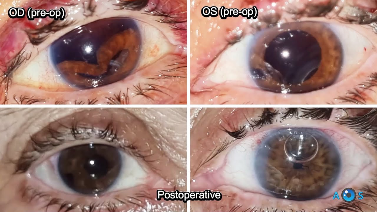 Complete Anterior Segment Repair after severe Eye Trauma with Airbag ...