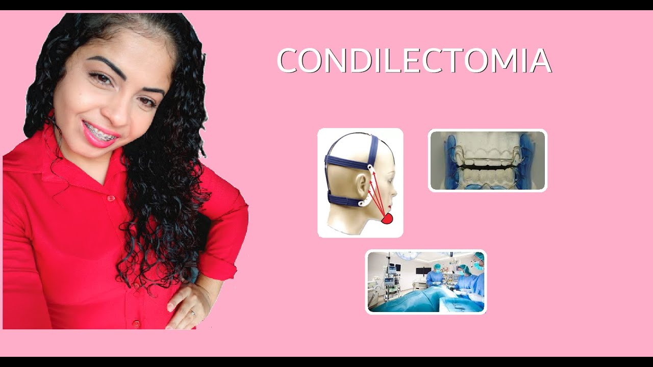 Condilectomia (Minha trajetória no uso de aparelho ortodôntico até a ...