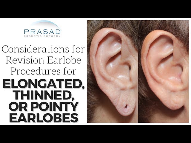 Pointy Ear Surgery