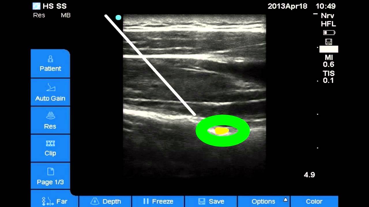 Shoulder Block: Part 3 of 3 - YouTube