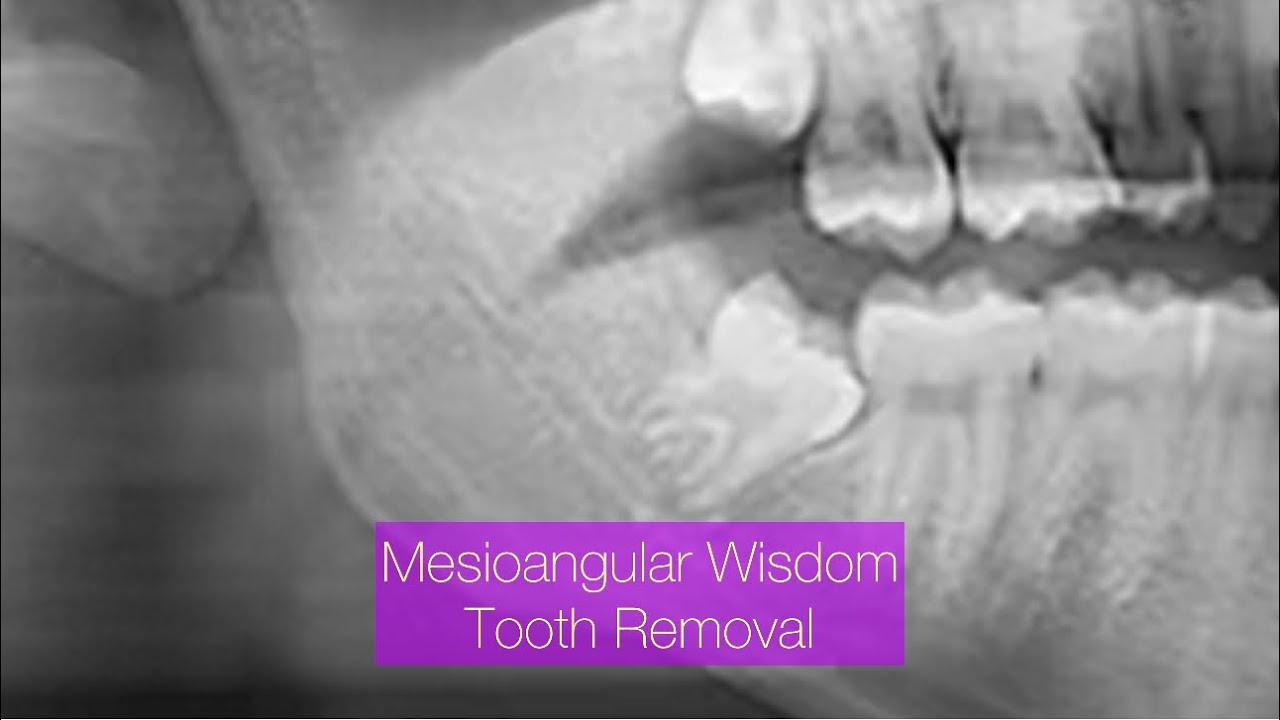 Mesioangular Wisdom Tooth Removal Step by Step @drwahan ...